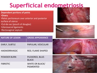 ENDOMETRIOSIS | PPTX