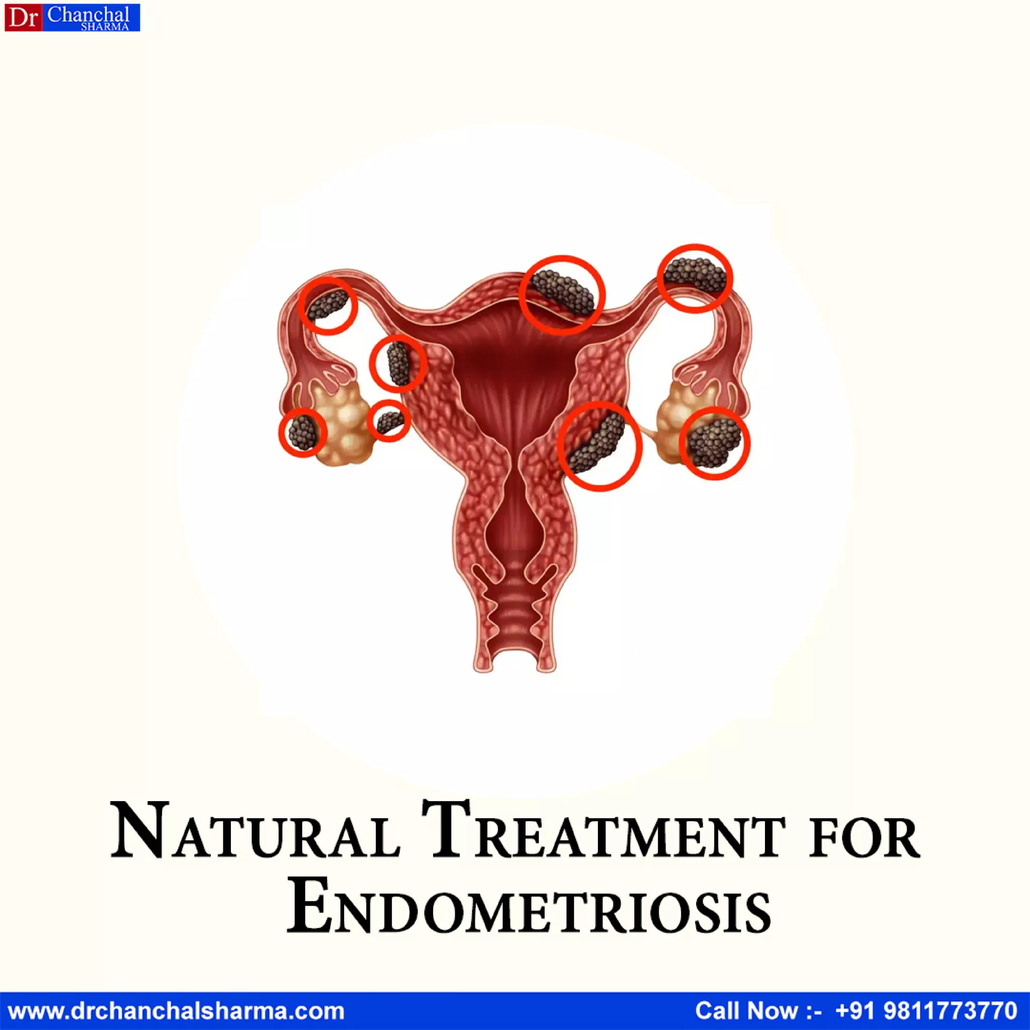 Endometriosis Natural Treatment Pdf 0817