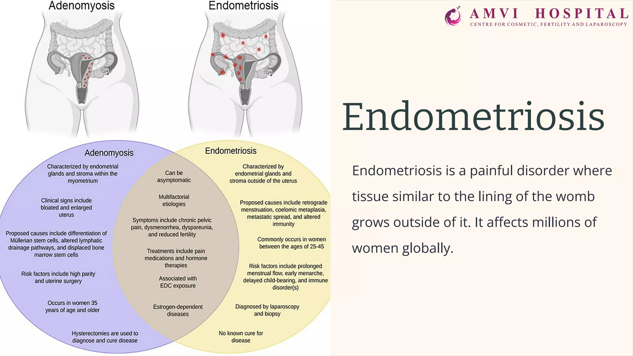 Endometriosis
