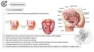 Endometriosis and Adenomyosis | PPTX