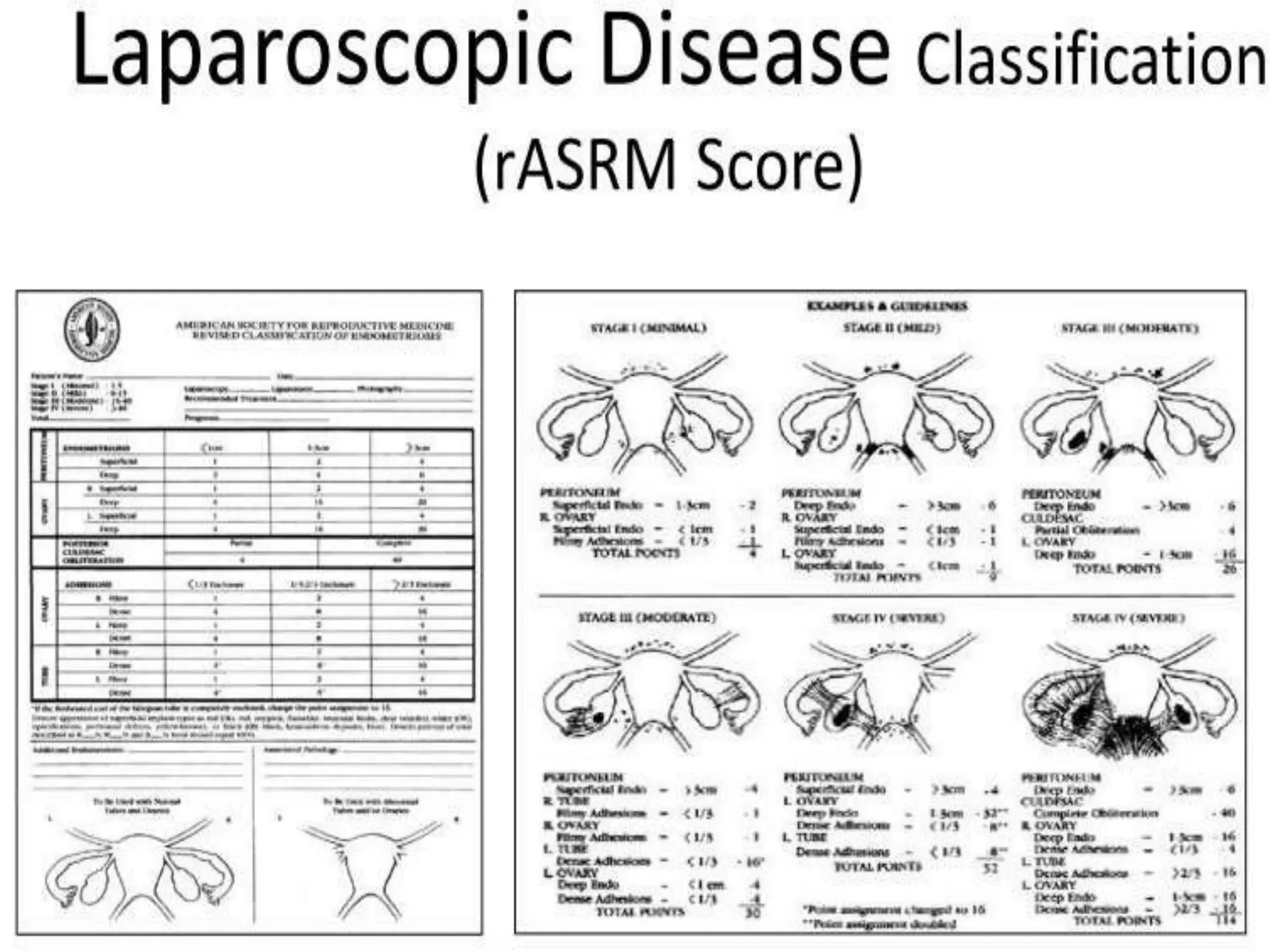 classification of endometriosis/staging/management | PPTX