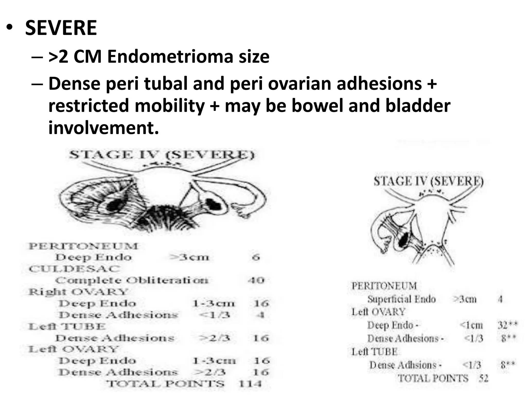 classification of endometriosis/staging/management | PPTX