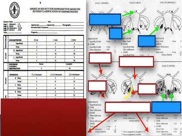 classification of endometriosis/staging/management | PPTX