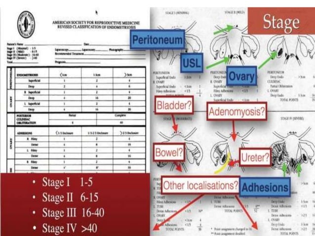 classification of endometriosis/staging/management | PPTX