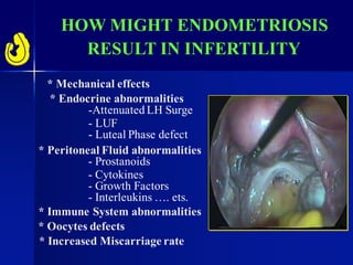 Endometriosis and Infertility | PDF
