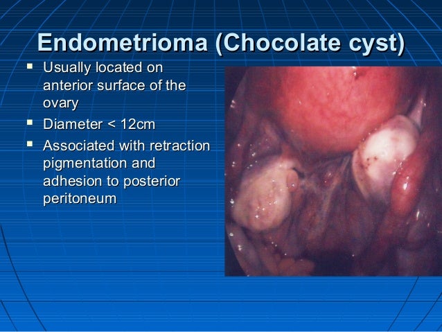 Endometriosis by Dr syeda komal