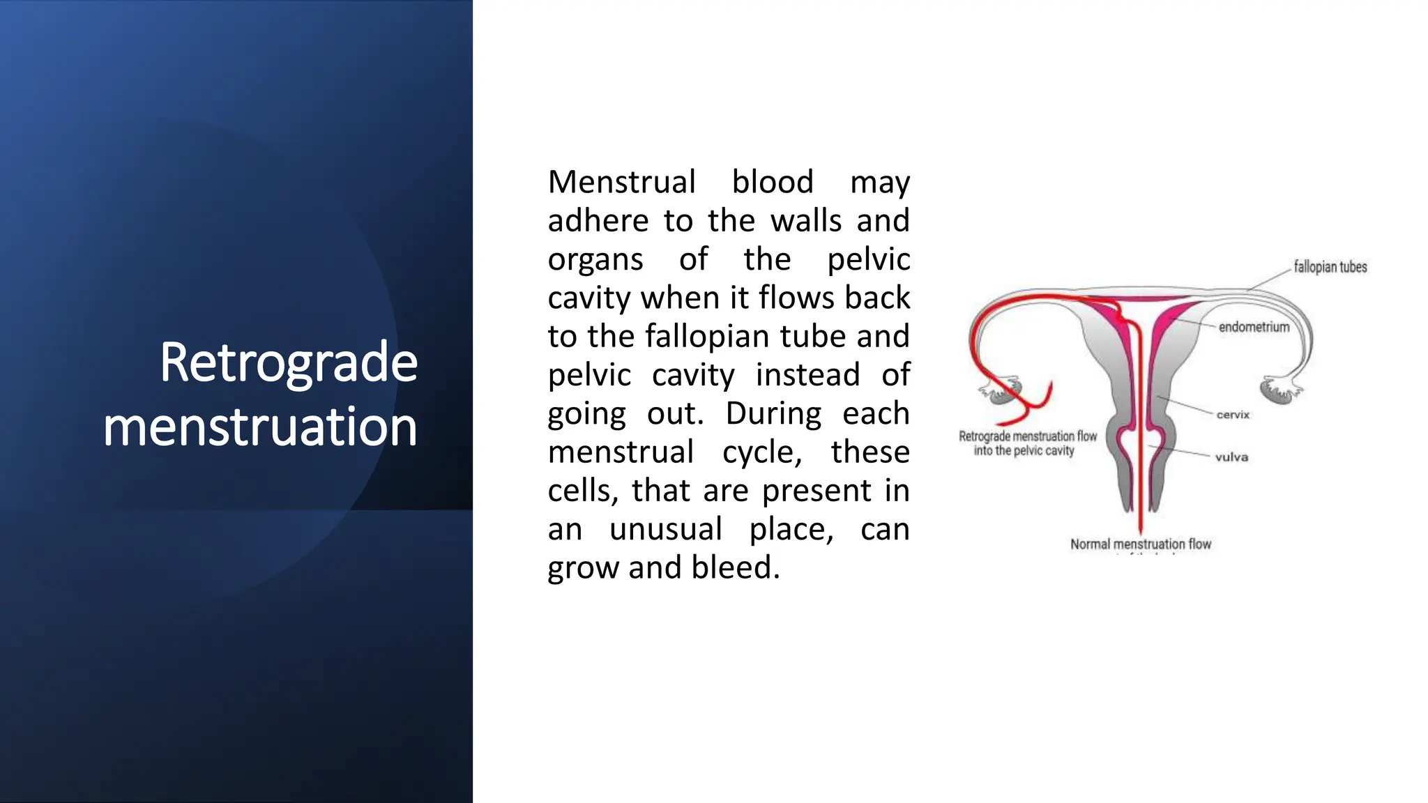 Endometriosis causes.pptx