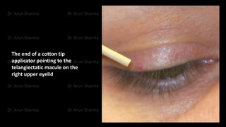 Endometriosis of the eyelid | PDF