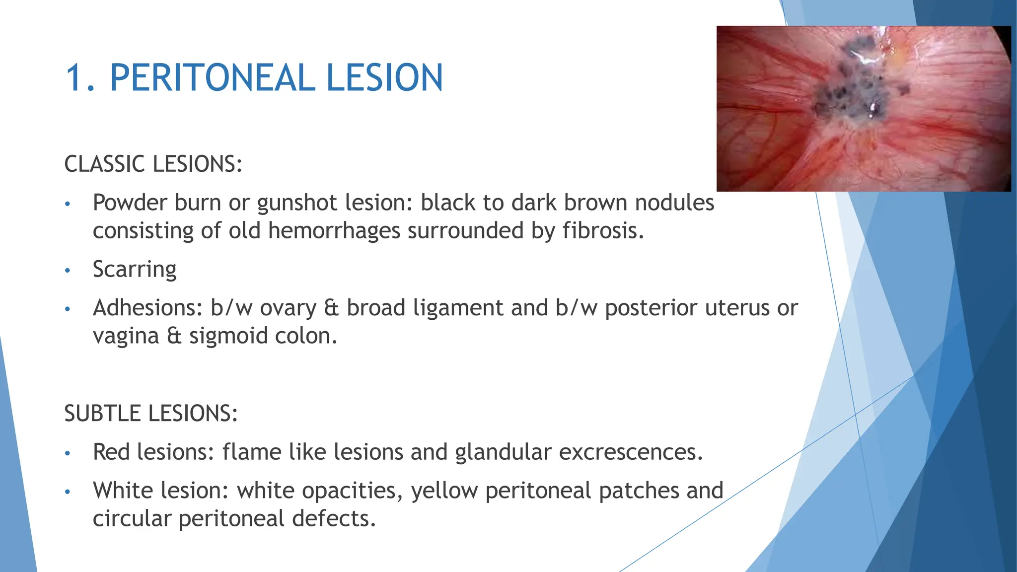 Endometriosis presented by Saima Q.pptx