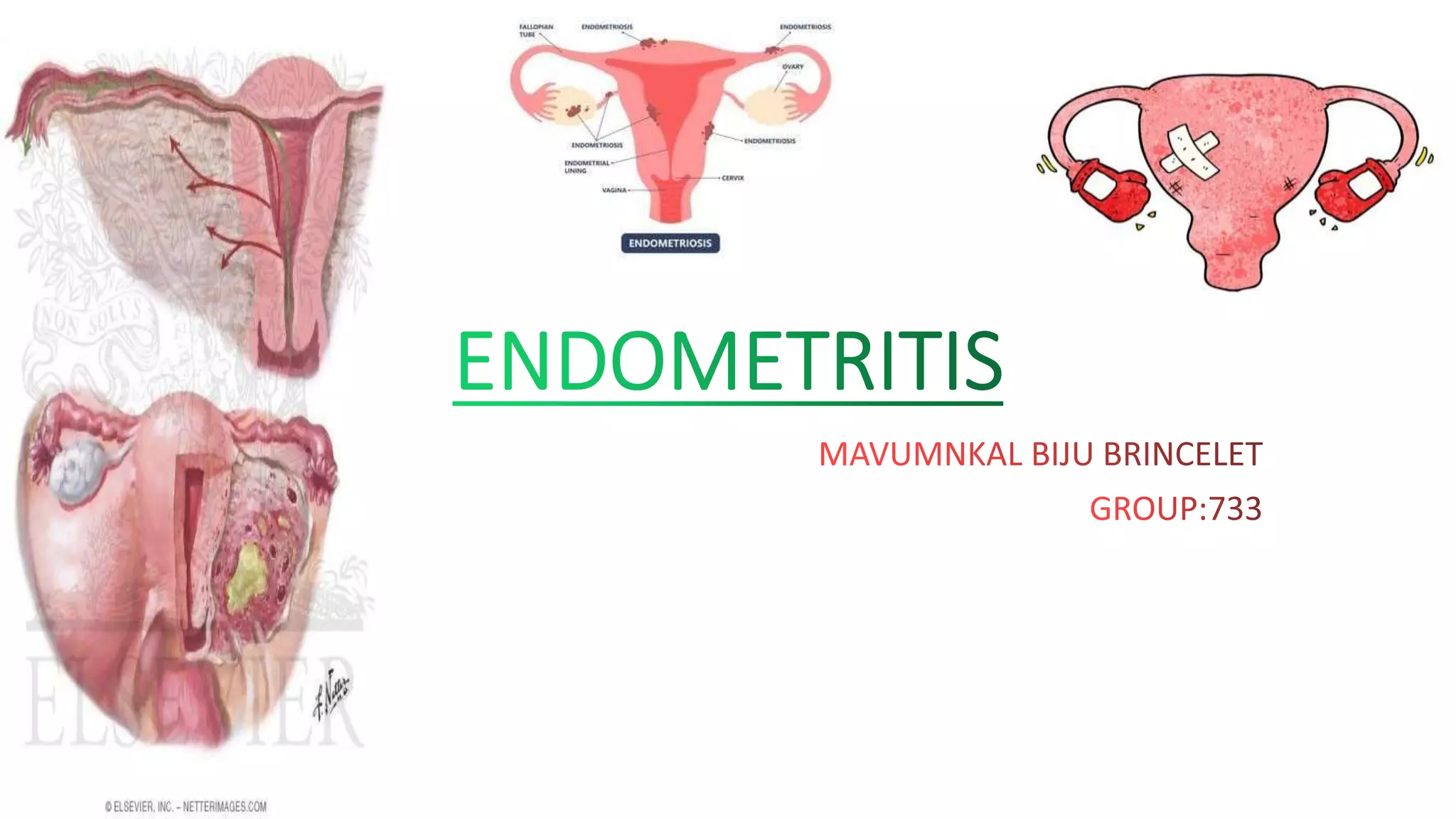 ENDOMETRITIS obstetric and gynecology . | PPTX