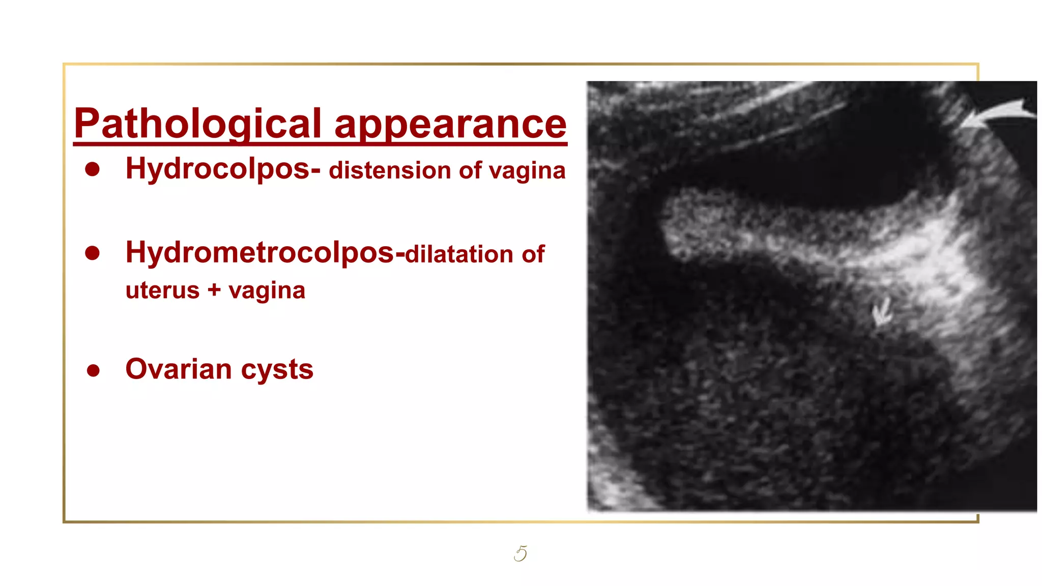 Endometrium and its pathologies | PPTX