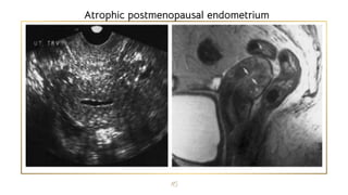 Endometrium and its pathologies | PPTX