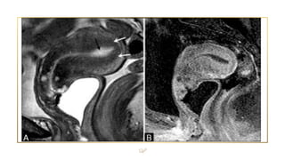 Endometrium and its pathologies | PPTX