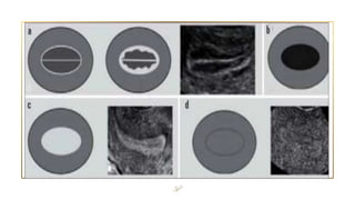 Endometrium and its pathologies | PPTX