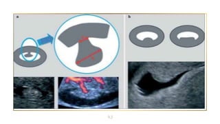 Endometrium and its pathologies | PPTX