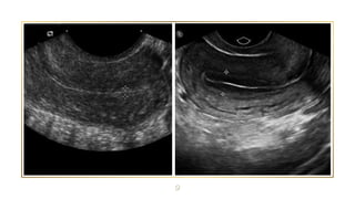 Endometrium and its pathologies | PPTX