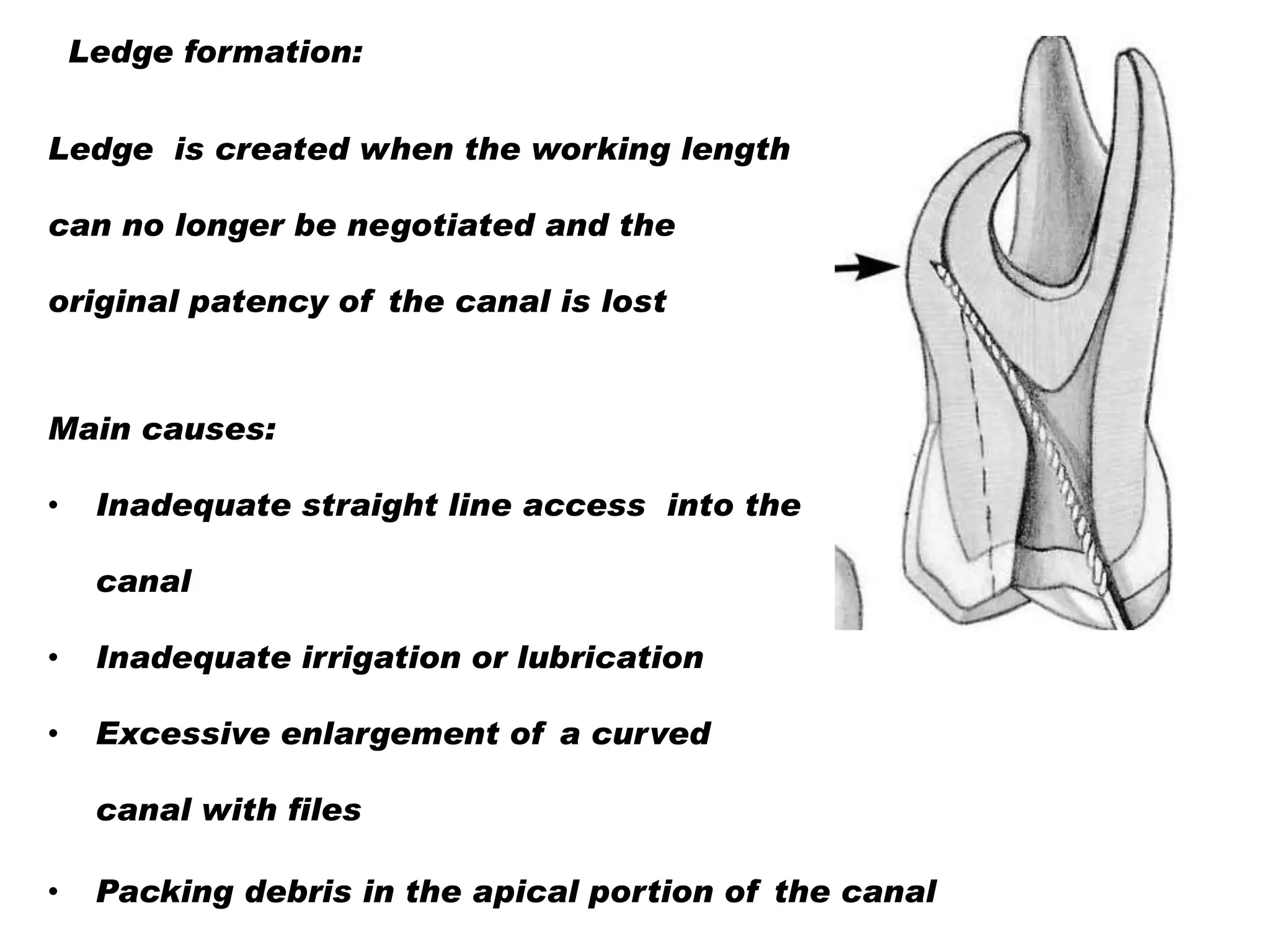 Endodontic Mishaps | PDF
