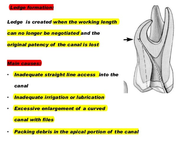 Endodontic Mishaps