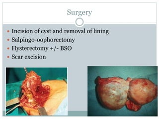 Endomtriosis seetesh mgmcri | PPTX