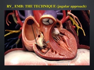 Endomyocardial Biopsy in Cardiac Catheterization Laboratory 2.0 updated ...