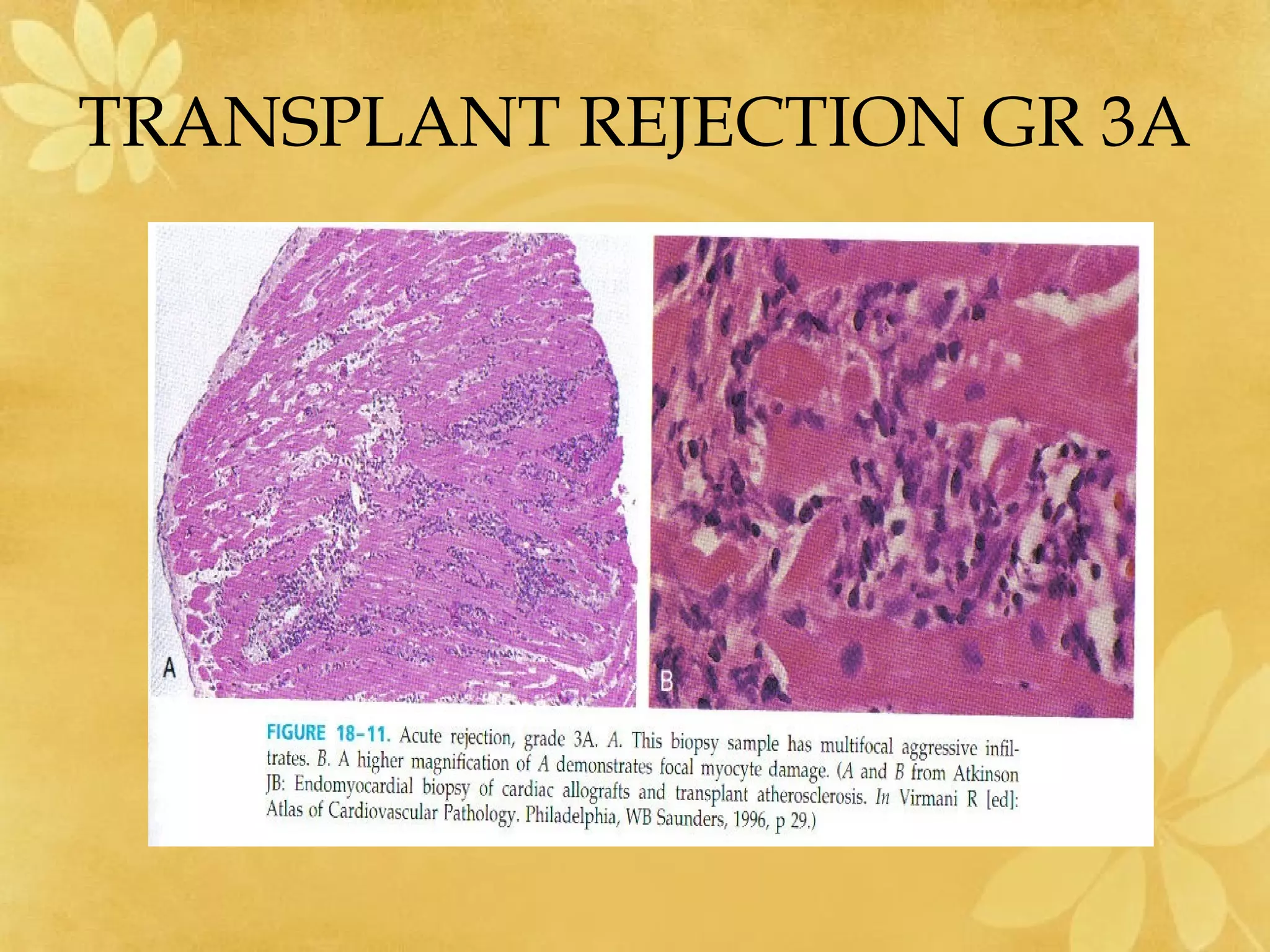 Endomyocardial biopsy | PPT