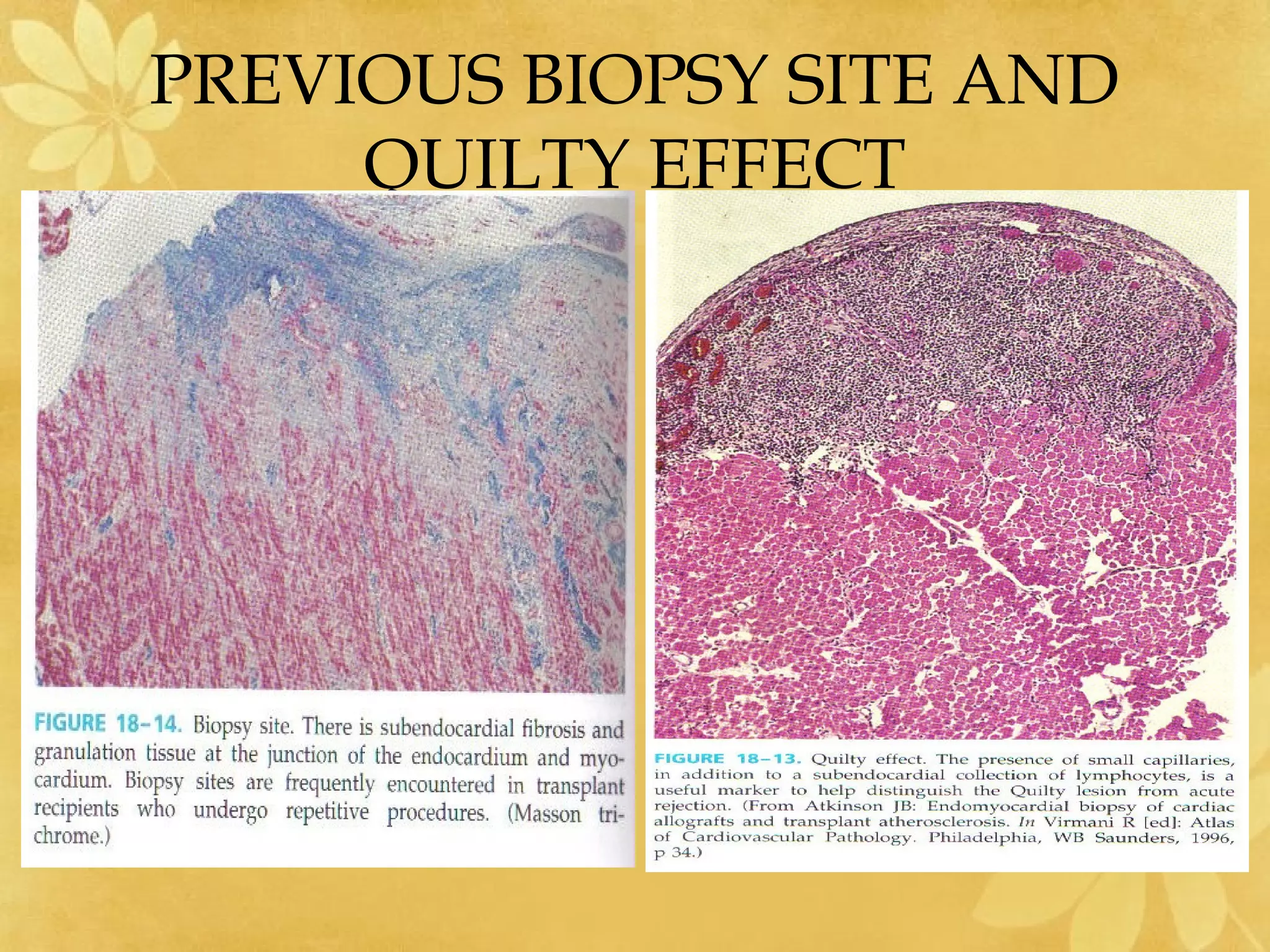 Endomyocardial biopsy | PPT