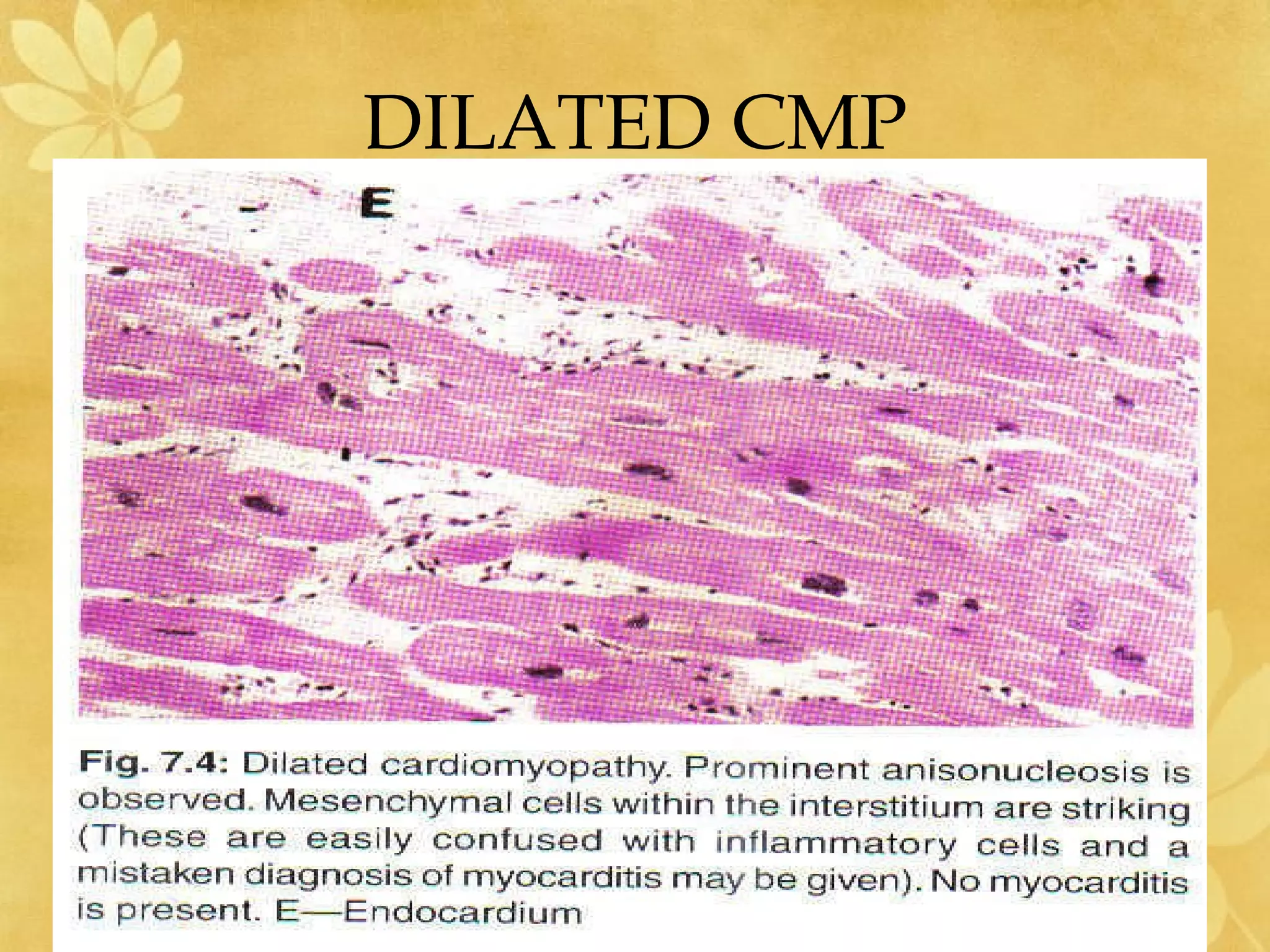 Endomyocardial biopsy | PPT