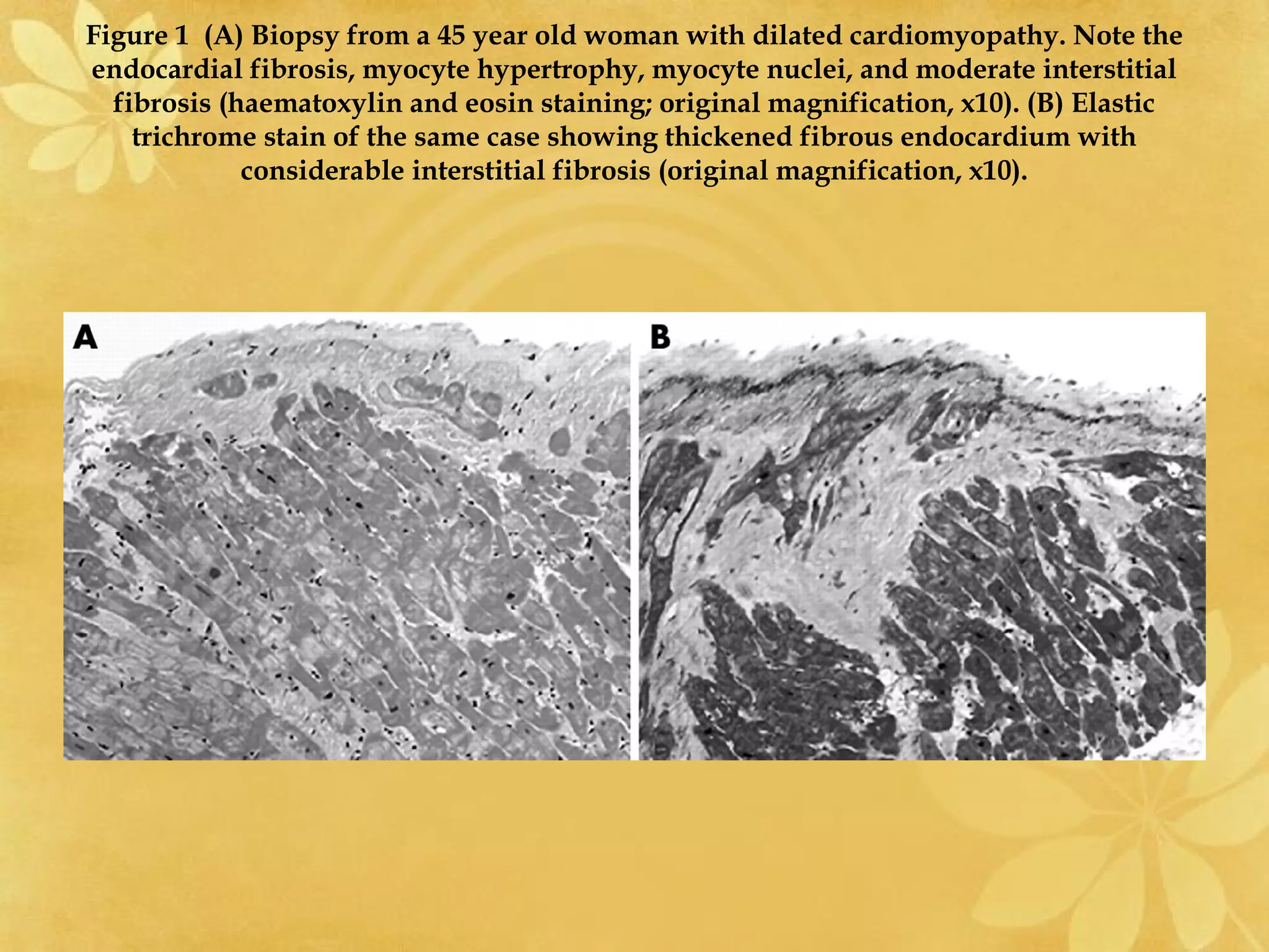 Endomyocardial biopsy | PPT