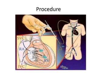 Endomyocardial biopsy and cardiomyopathy final | PPTX
