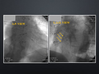 Endomyocardial Biopsy in Cardiac Cath Lab 2.0 updated.pptx