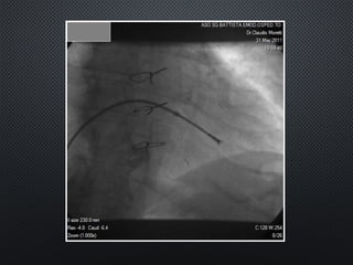 Endomyocardial Biopsy in Cardiac Cath Lab 2.0 updated.pptx