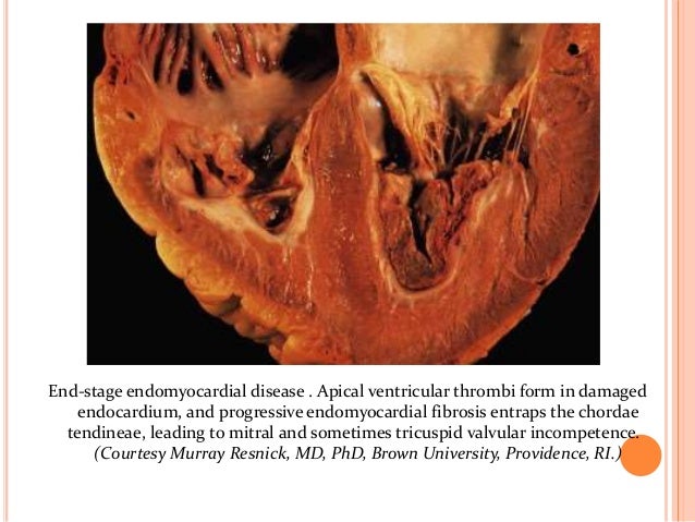 ENDOMYOCARDIAL FIBROSIS