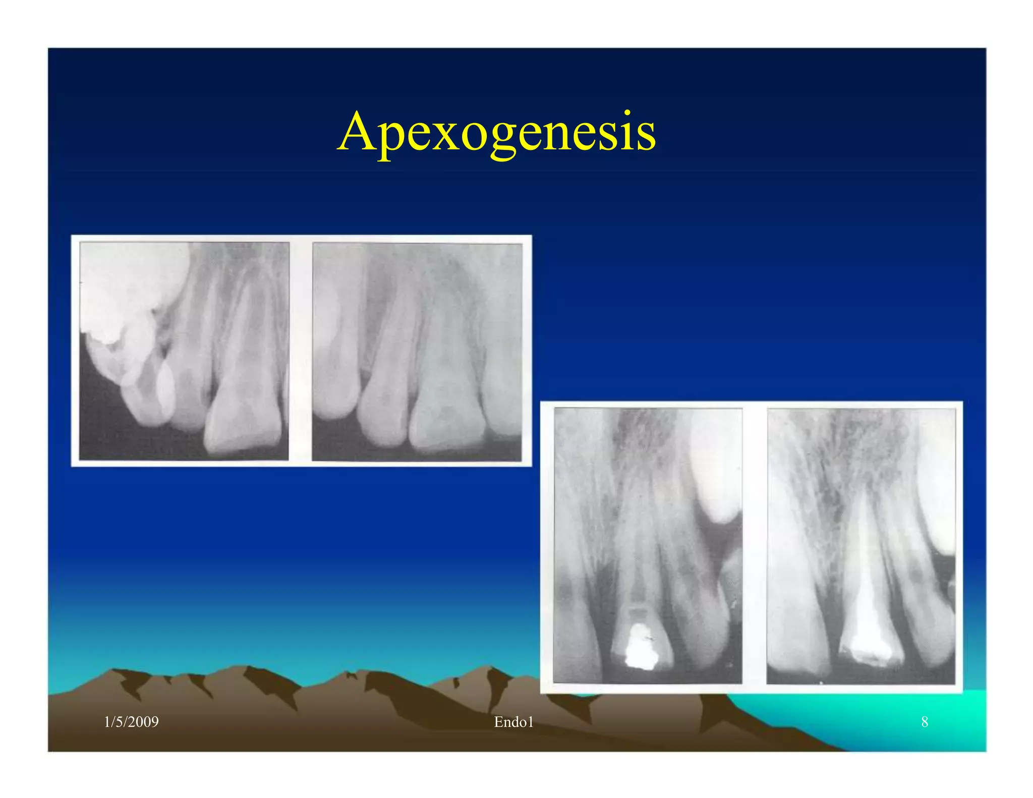 Endo note 1 definition and history | PPTX