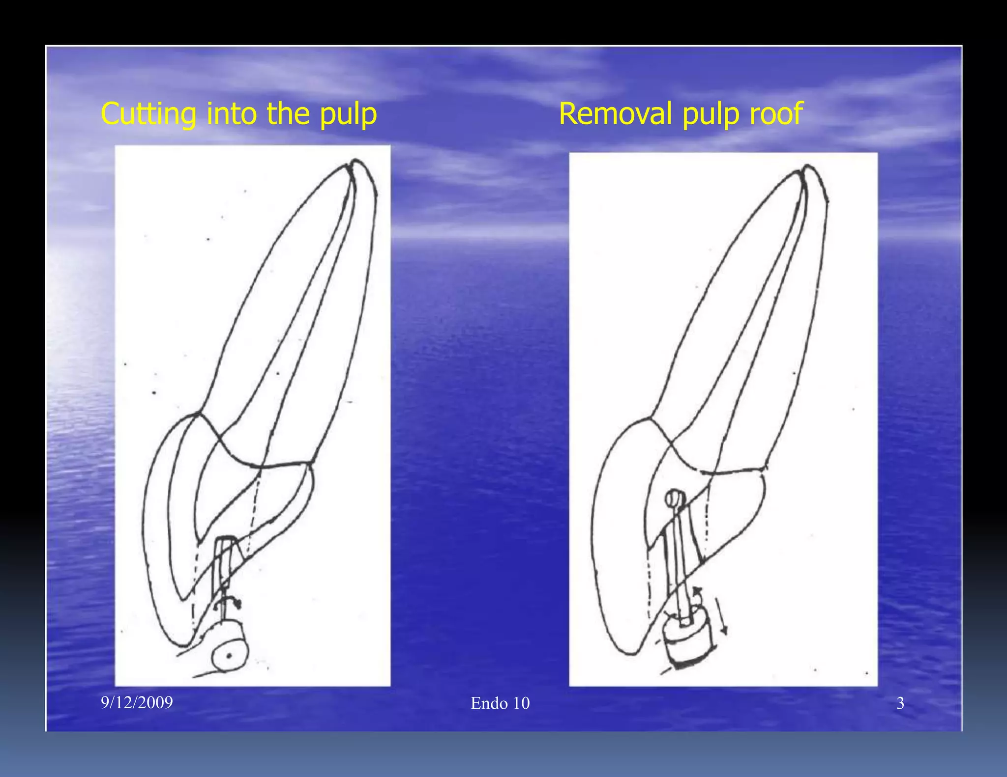 Endo note 10 preparation of straight canal | PPTX