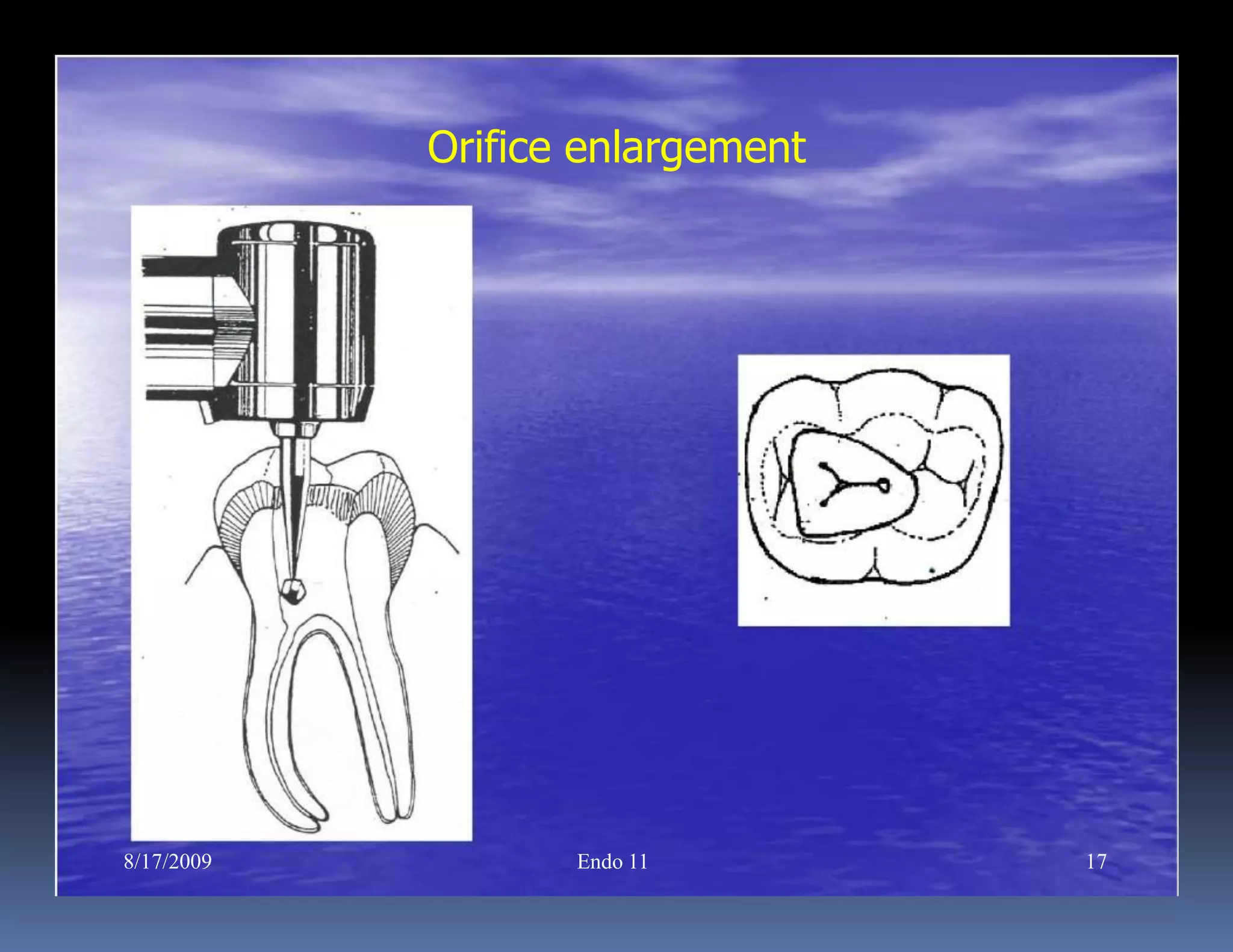 Endo note 11 peparation of curved root canal | PPTX
