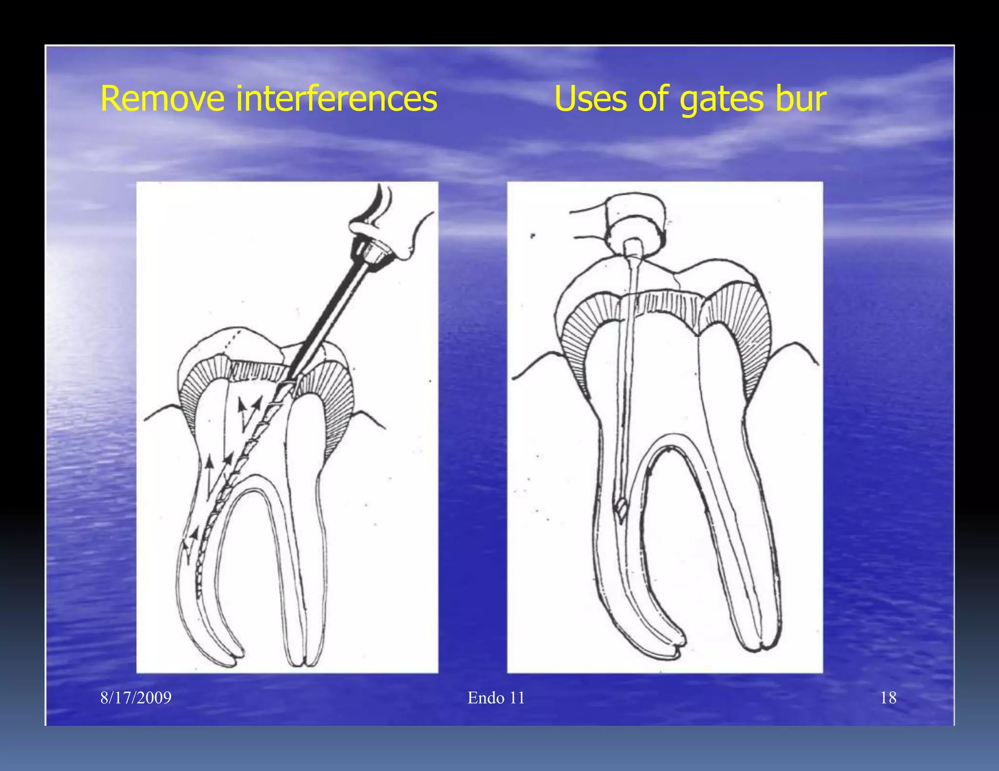 Endo note 11 peparation of curved root canal | PPTX