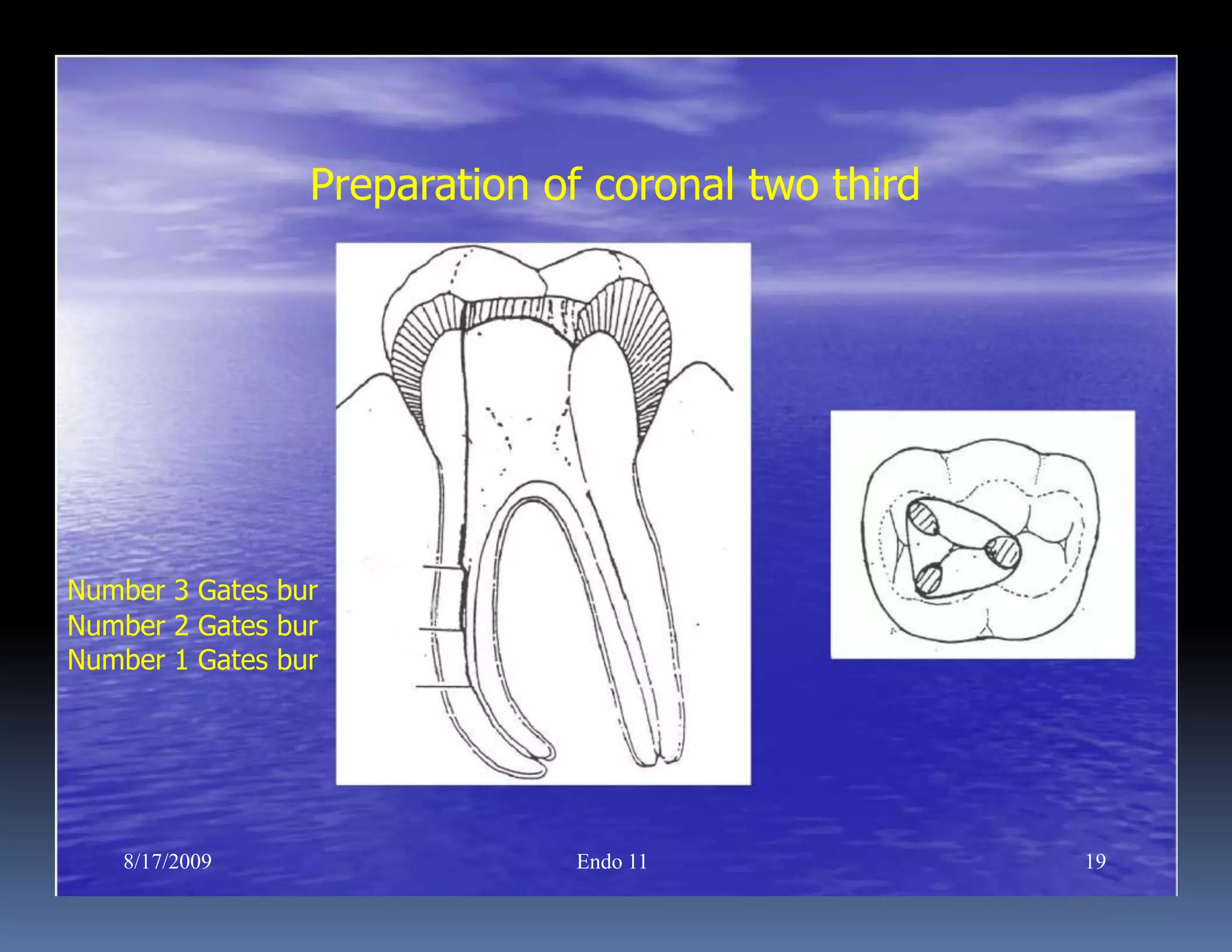 Endo note 11 peparation of curved root canal | PPTX