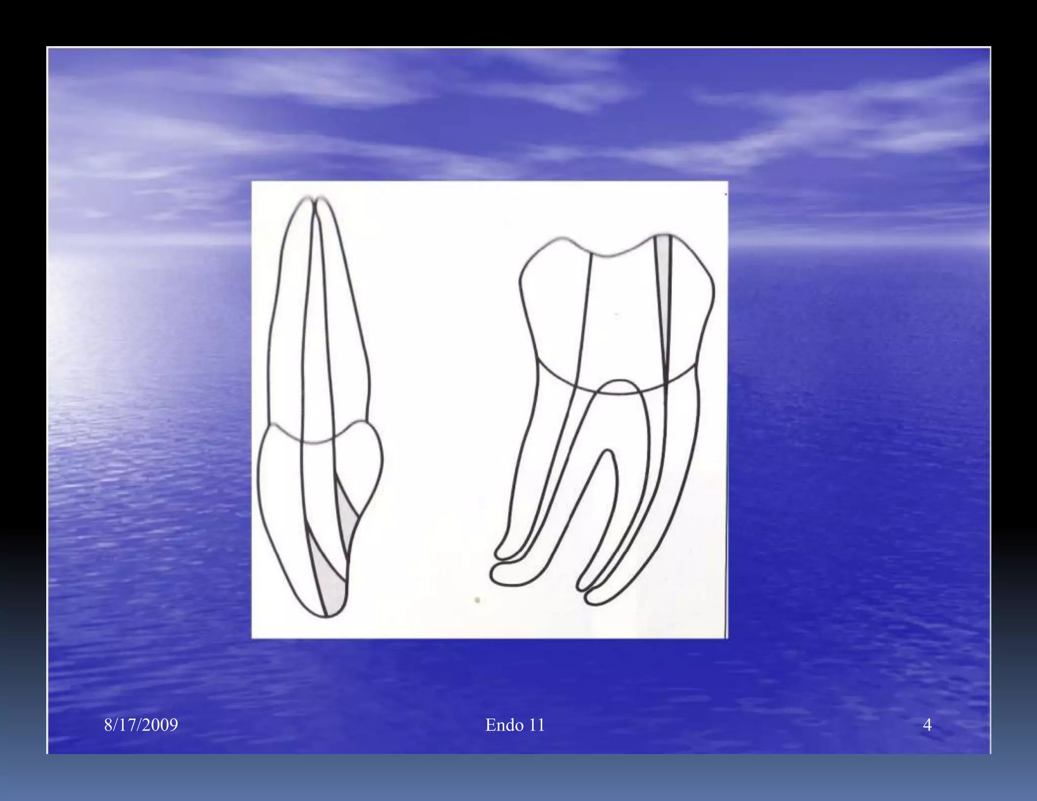 Endo note 11 peparation of curved root canal | PPTX
