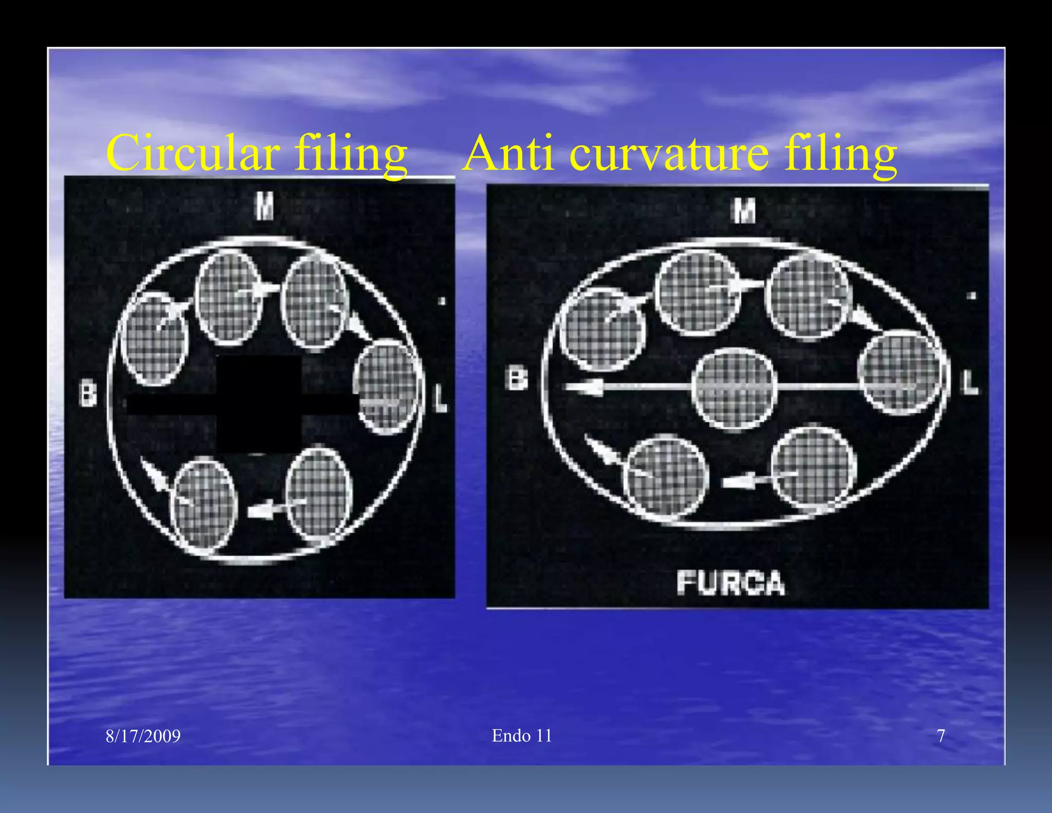 Endo note 11 peparation of curved root canal | PPTX