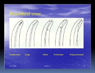 Endo note 11 peparation of curved root canal | PPTX