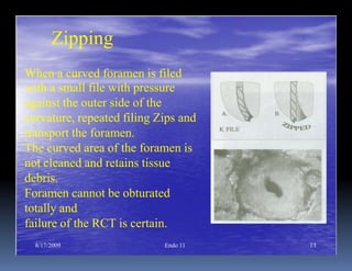 Endo note 11 peparation of curved root canal | PPTX