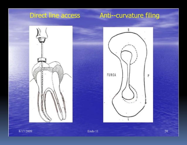 Endo note 11 peparation of curved root canal | PPTX