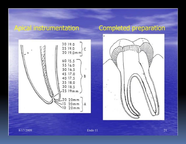 Endo note 11 peparation of curved root canal | PPTX