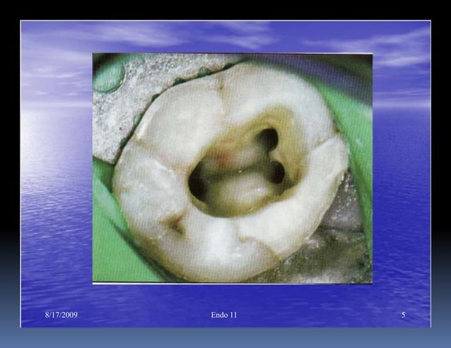 Endo note 11 peparation of curved root canal | PPTX