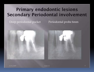 Endo note 13 perioendolesion | PPTX