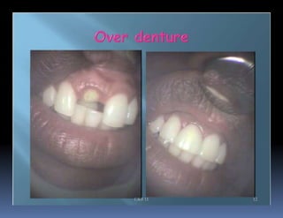 Endo note 16 restoration of root filled | PPTX