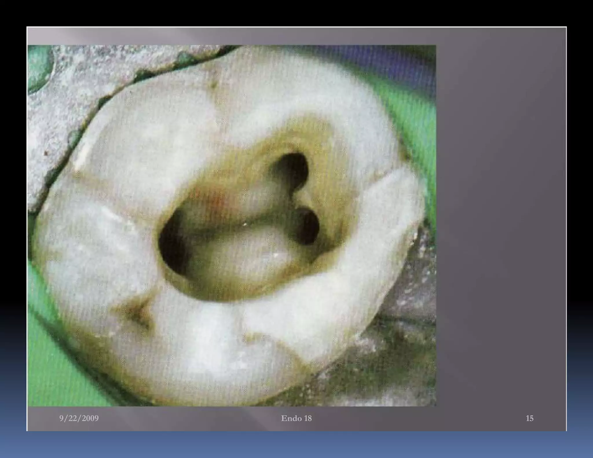 Endo note 18 ledge formation | PPTX