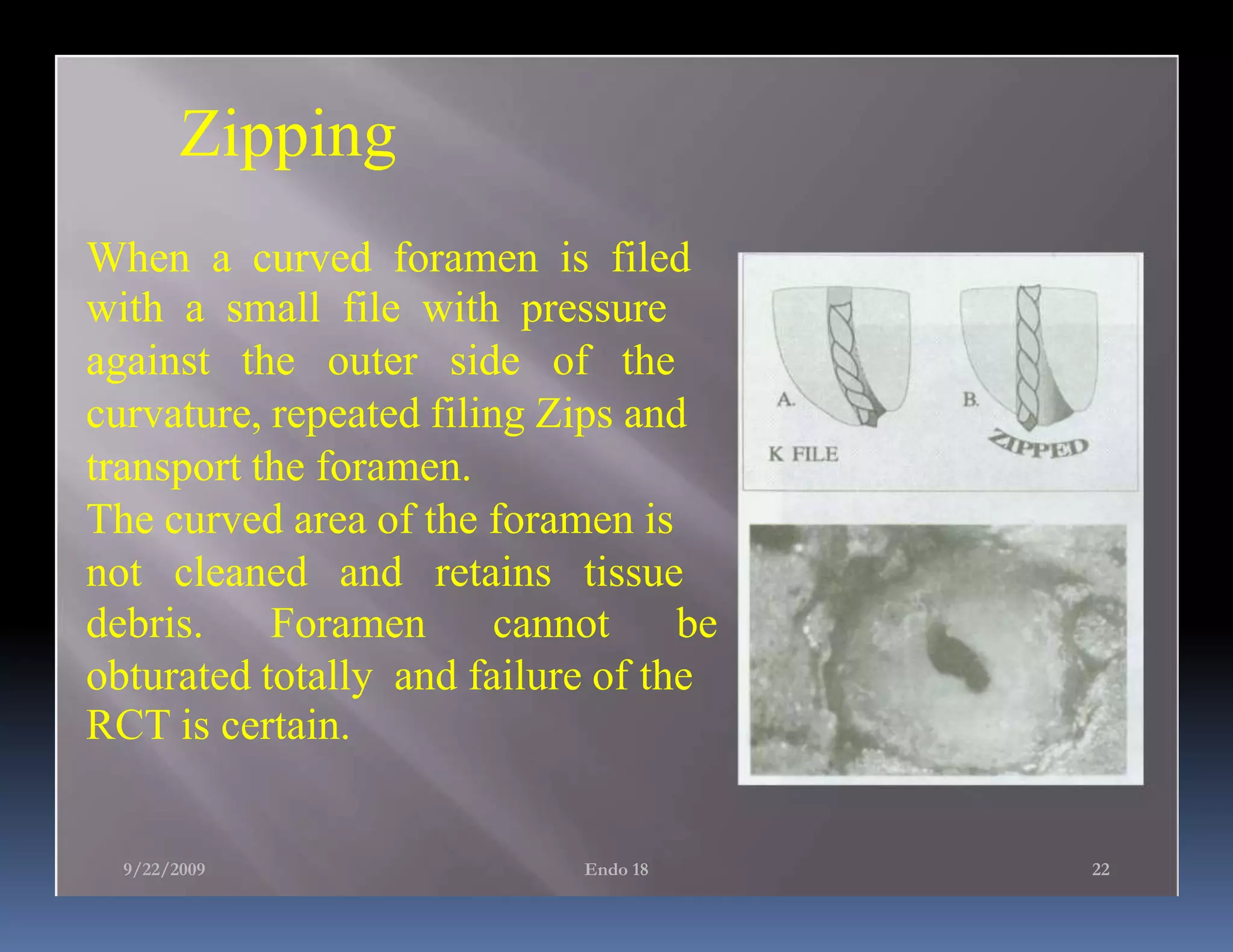 Endo note 18 ledge formation | PPTX