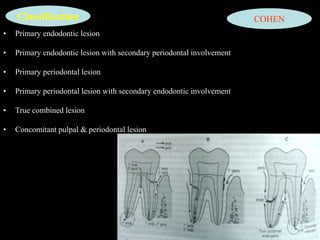 Endo perio for the class | PPT