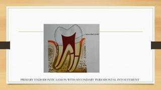 Endodontic Periodontic Lesions copy.pptx
